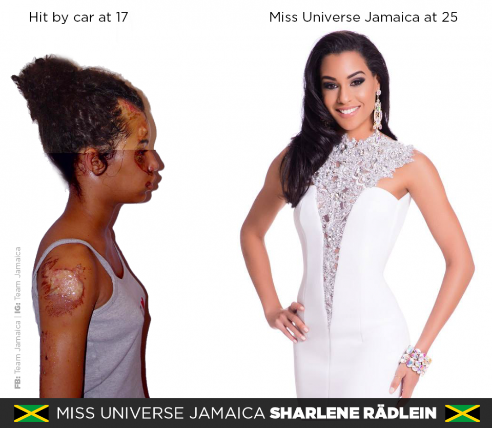 Miss Universe Jamaica Sharlene Radlein hit by car at 17 - Team Jamaica